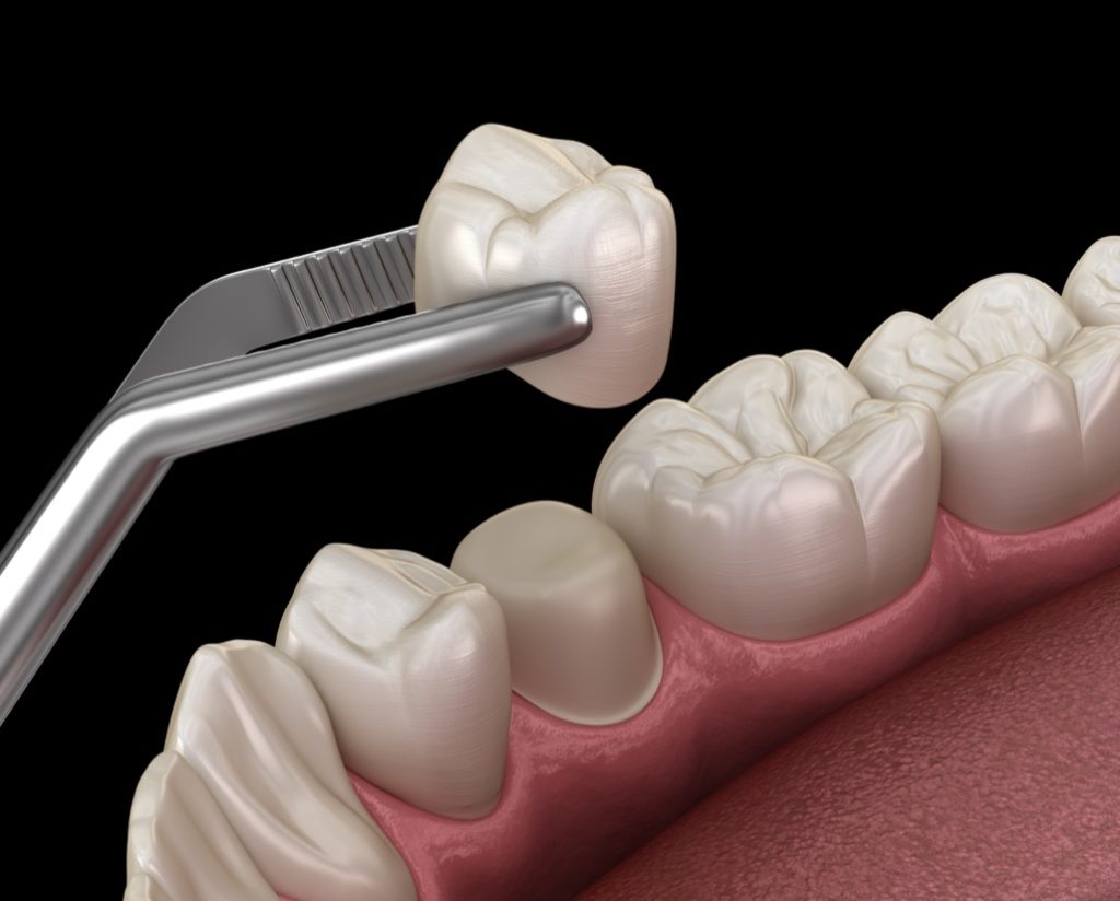 Dental Crowns Near Me in Cleburne and Weatherford